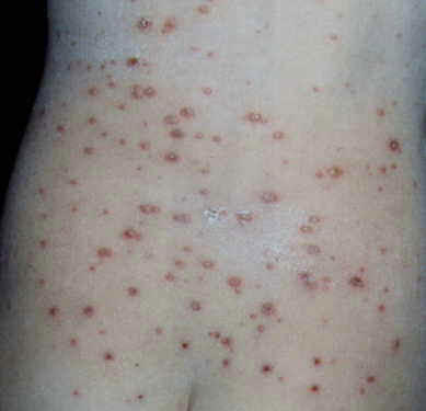 Windpocken – Kinderarzt Dr. Peter Henselmann